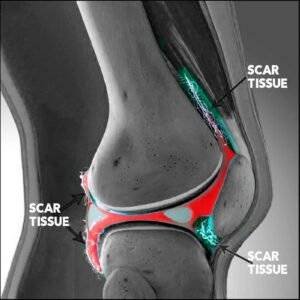 STAK Explained - STAK Knee Stretcher
